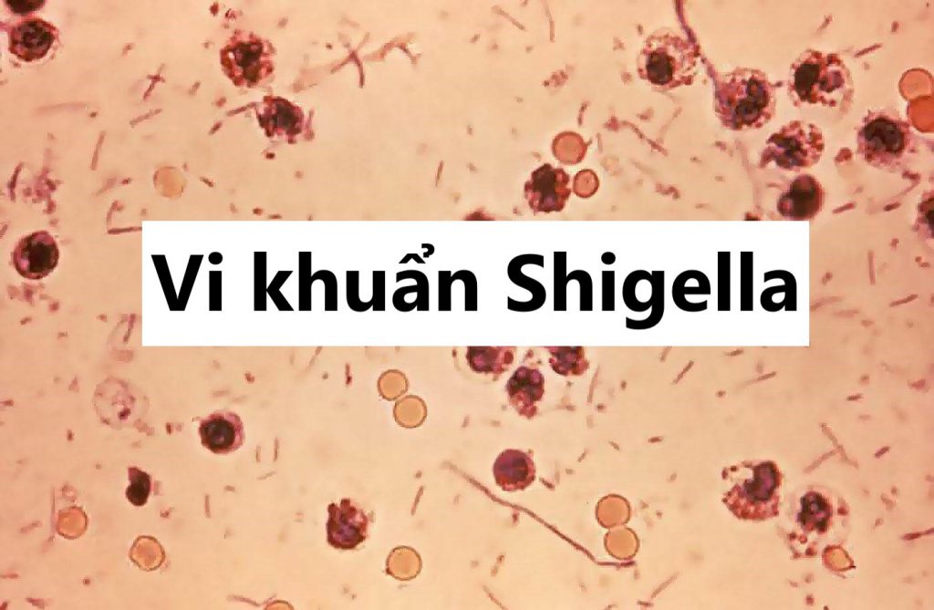 Shigella: Nguyên nhân, triệu chứng và cách phòng ngừa khuẩn Shigella
